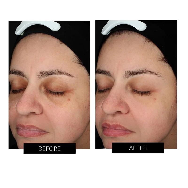 Foreo, FAQ102 RF Radio Frequency EMS & LED Device